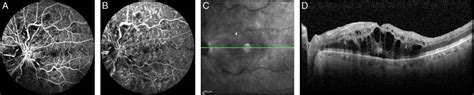 Multimodal Retinal Imaging Of Central Retinal Vein Occlusion Widefield Download Scientific