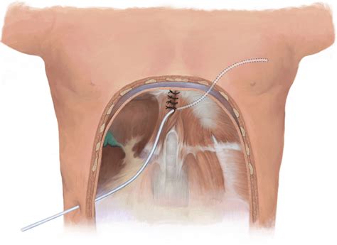 Representation Of The Intraoperative Insertion Of The Blake Drain From