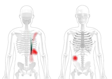 Iliocostalis Thoracis Trigger Points Overview Self Treatment Tips