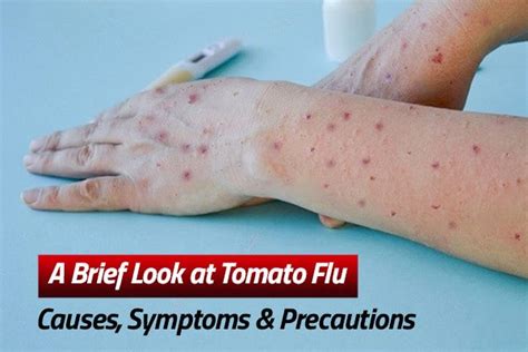 Tomato Flu Causes Symptoms Treatment And Prevention Tips