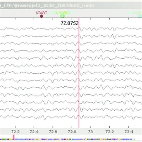 Brainstorm Features Multiple Solutions For The Visualization Of Megeeg Download Scientific