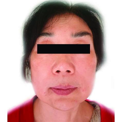 Guidance For Injecting Botulinum Neurotoxin Into The Corrugator