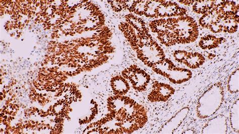 Understanding Ihc Staining For Accurate Tissue Analysis