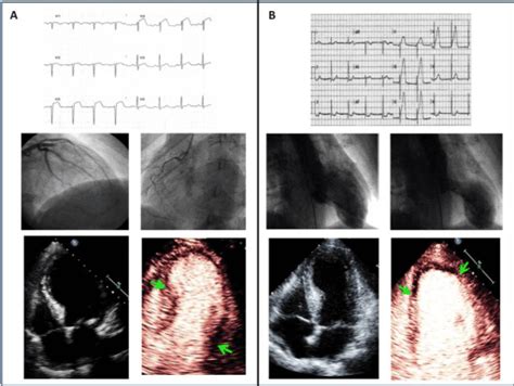 Gender Differences In Cardiovascular Disease
