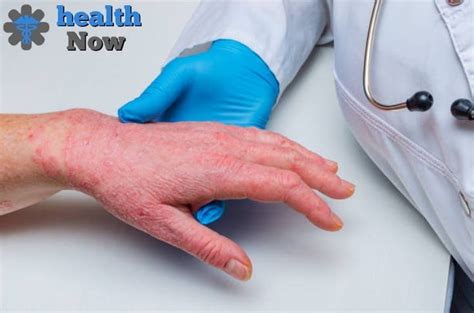 What Causes Liver Disease Itching And How To Treat It Stay Healthy With Health Now Medium