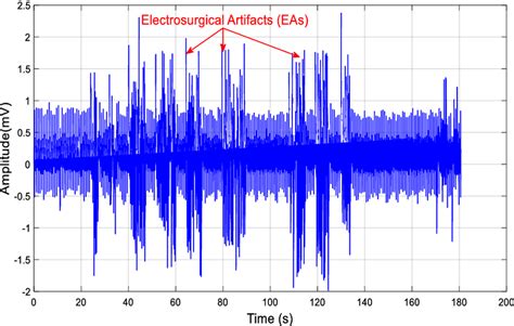 Ecg Signal With Electrosurgical Artifacts Eas Download Scientific