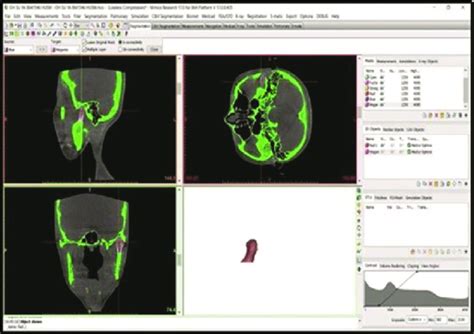 Determination Of Condylar Volume Using Mimics Software Materialize Download Scientific Diagram