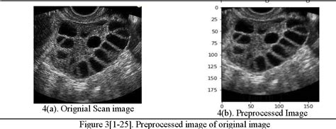 Figure 3 1 From Classification Of Pcos Using Machine Learning