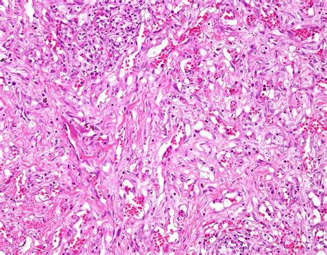 Angiosarcoma Of Breast Light Micrograph Stock Image C049 1185 Science Photo Library