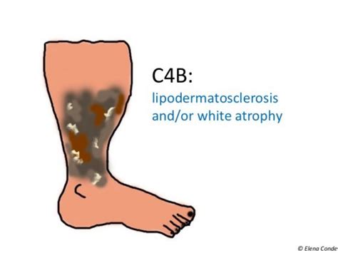Chronic Venous Insufficiency From A Dermatological Perspective Elena Conde