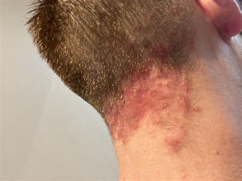 Update Akn Rfolliculitis