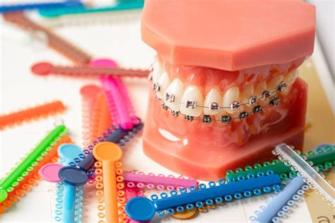 How Do Braces Work Everything You Need To Know