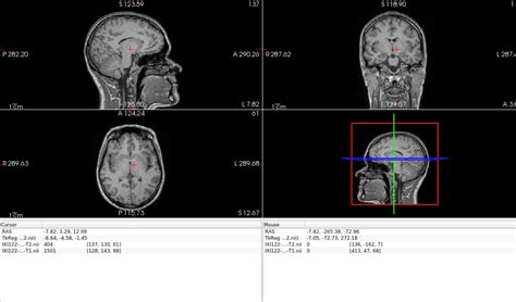 tms optimization · issue 62 · simnibs simnibs · github