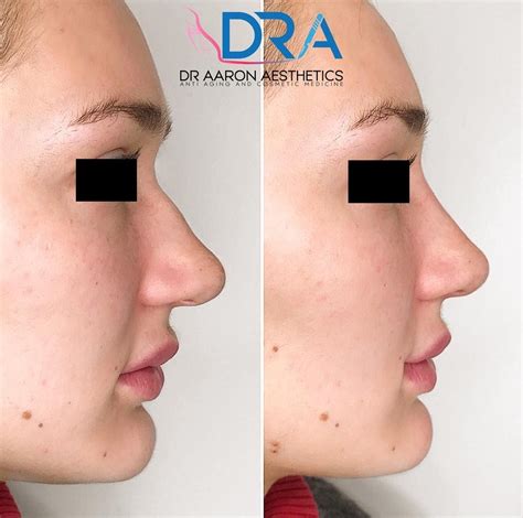 Non Surgical Rhinoplasty Purpose To Hide Bumps Straighten Your Nose Build A Nose Bridge Or