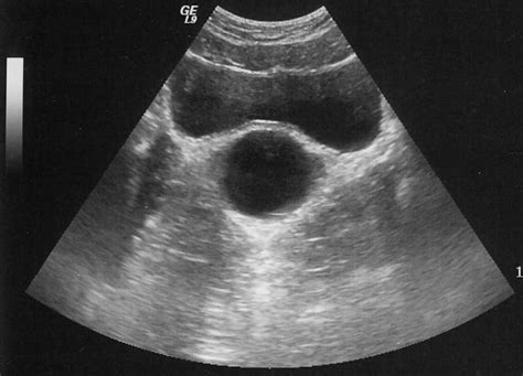 Prostatic Utricle Cyst