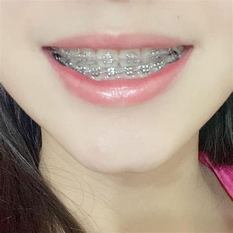 Pin By Maryam On Quick Saves Cute Braces Braces Colors Cute Braces