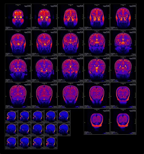 Brain Magnetic Resonance Imaging Mri Revealed An Old