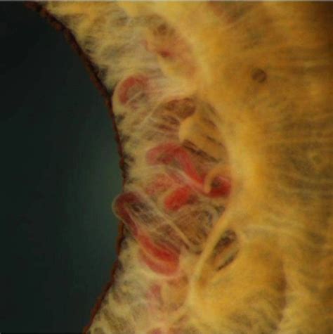 Mutaz Alfadil Ncmhp Comt On Linkedin Iris Arteriovenous Malformation ️iris Arteriovenous