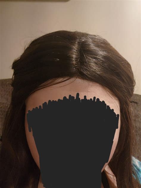 On Dutasteride Had My Dht Levels Checked For The First Time Ever R