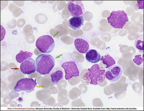 Centroblastic Morphological Variant CELL Atlas Of Haematological
