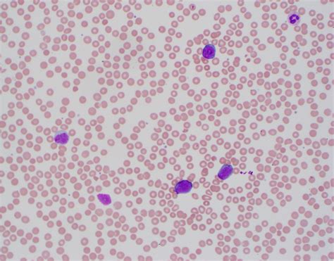Pathology Outlines Burkitt Lymphoma