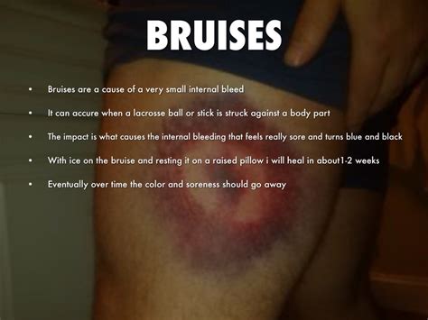 Internal Bleeding Bruises