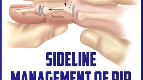 Distal Phalanx Dislocation