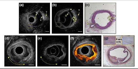 Figure 2 From A Review Of Intravascular Ultrasound Based Multimodal Intravascular Imaging