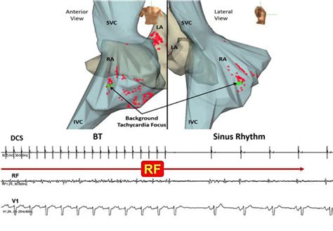 Upper 3 D Geometric Endocardial Reconstruction Of The Left And Right Download Scientific