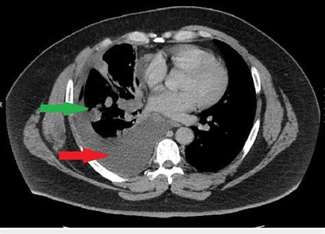 Ct Scan Showing Right Sided Lung Mass Green Arrow And Pleural Download Scientific Diagram