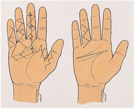 Subtotal Palmar Fasciectomy For Dupuytrens Contracture Musculoskeletal Key