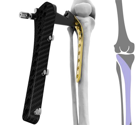 Tibia Proximal 45 50mm Astrolabe