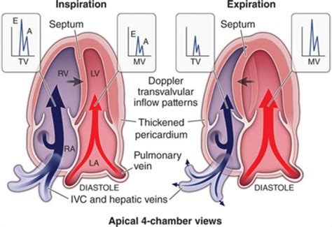 Basic Echo 150 Constrictive Pericarditis Powerpoint Flashcards Quizlet