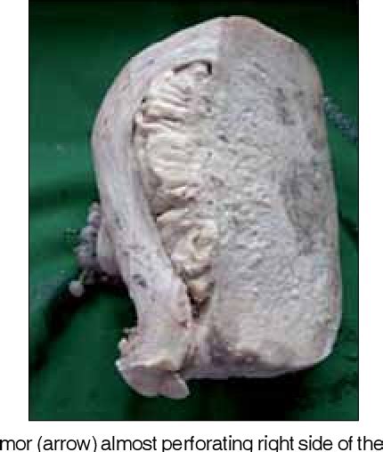 Figure 3 From Endometrial Stromal Sarcoma Semantic Scholar