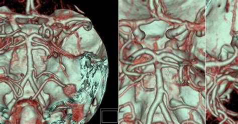 Persistent Trigeminal Artery