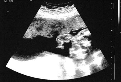 Routine Second Trimester Us Performed At 19 Weeks Of Gestation Showing Download Scientific