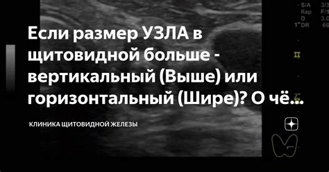 Если размер УЗЛА в щитовидной больше вертикальный Выше или горизонтальный Шире О чём