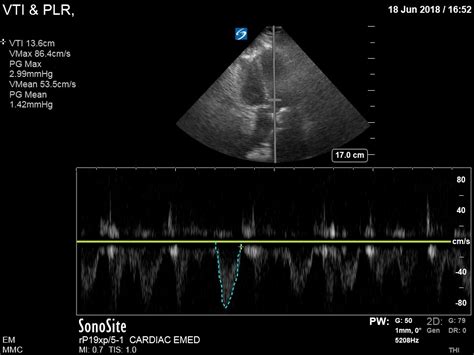Velocity Time Integral VTI And The Passive Leg Raise Taking Volume Assessment To The Next