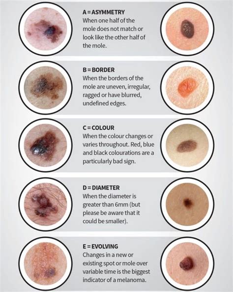 Dermatology 102 Abcde Rule Of Melanoma Gp Exams