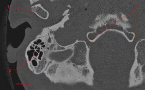 CT Scan Of The Temporal Bone W Radiology