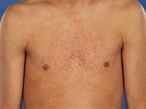 Angiokeratoma Causes Types And Angiokeratoma Treatment