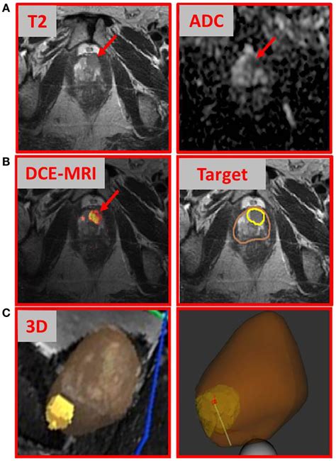 Multiparametric Mri Findings And Directed Prostate Biopsy Of The Index