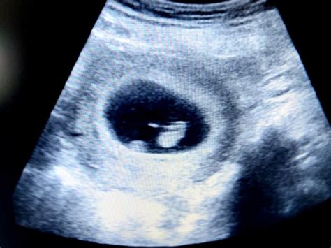 Janin 6 Minggu Inilah Perkembangan Dan Tips Menjaga Kesehatannya