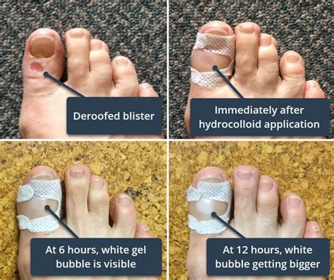 Do Hydrocolloid Bandages Work On Blisters At Tasha Hyman Blog