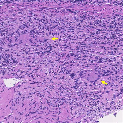 Biopsy Specimens Showing Granulomatous Infiltrates Composed Of