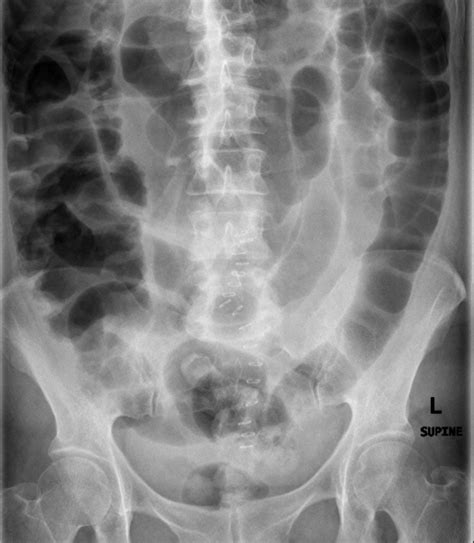 10 3 Ileus Medicine Libretexts