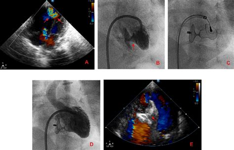 Mid Muscular Vsd Panel A Tee 4 Chambers View Shows The Download Scientific Diagram