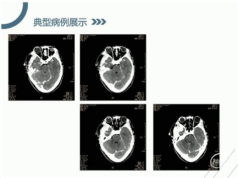 朱永华主任医师：岩斜区脑膜瘤手术治疗初探 脑医汇