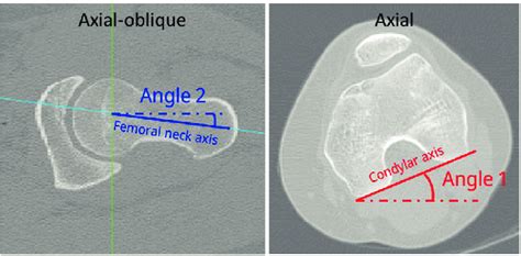 In The Standard Radiological Practice Femoral Torsion Is Measured On Download Scientific