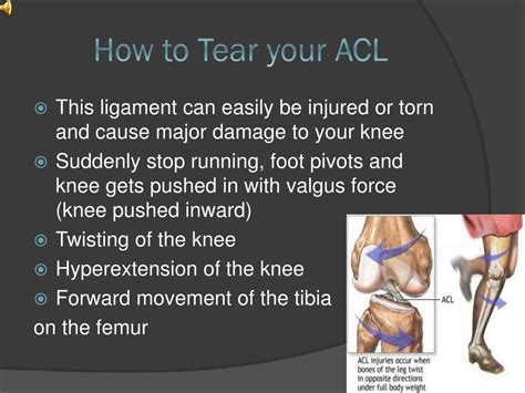PPT Physical Therapy ACL Tears PowerPoint Presentation Free Download ID